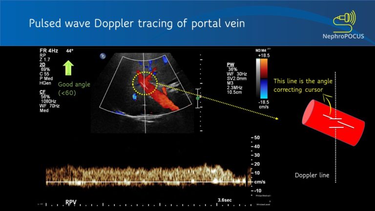 Basics of Doppler Ultrasound for the Nephrologist- Part 2 - Renal ...
