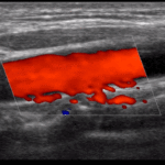 Basics of Doppler Ultrasound for the Nephrologist- Part 2 - Renal ...