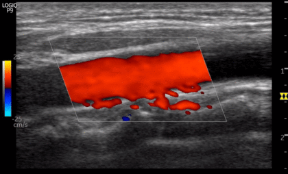Lithium and the Kidneys: What Every Nephrologist Should Know - Renal ...