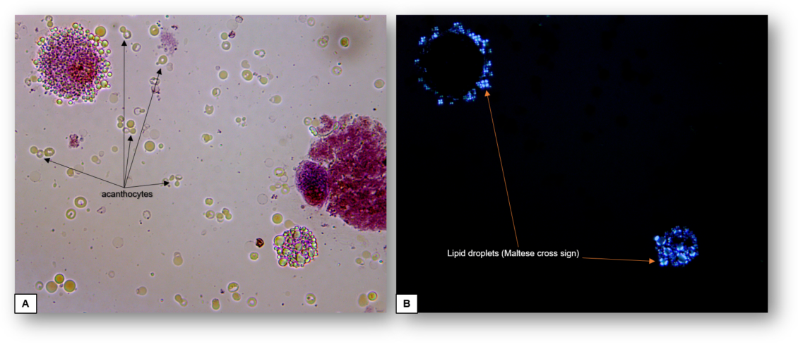 Urine Sediment of the Month: Evidence of Nephritic & Nephrotic Syndrome ...