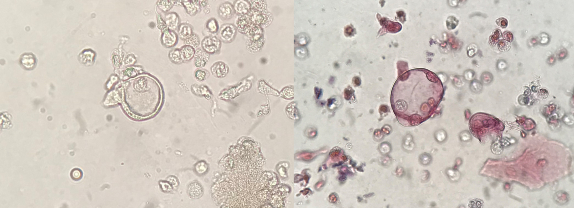 Urine Sediment of the Month: When you Hear Hoofbeats... Unusual Cell ...