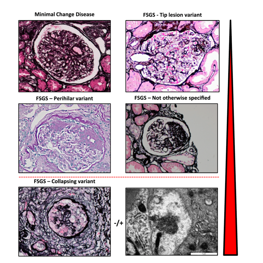 Kidney Biopsy of the Month: Focal Segmental Glomerulosclerosis - Renal ...