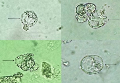 Urine Sediment of the Month: When you Hear Hoofbeats... Unusual Cell ...