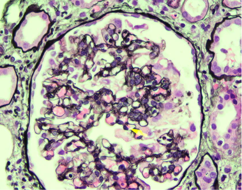 Kidney Biopsy of the Month: Focal Segmental Glomerulosclerosis - Renal ...