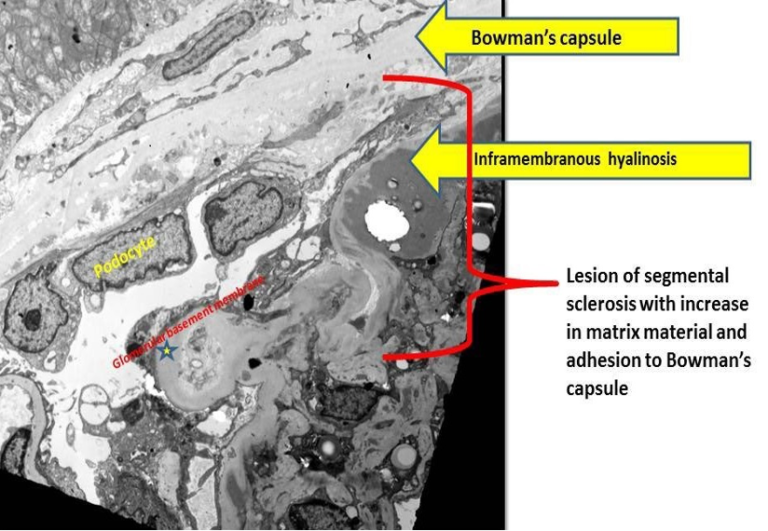 Kidney Biopsy of the Month: Focal Segmental Glomerulosclerosis - Renal ...