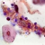 Urine Sediment of the Month: Mixed Cellular Casts - Renal Fellow Network