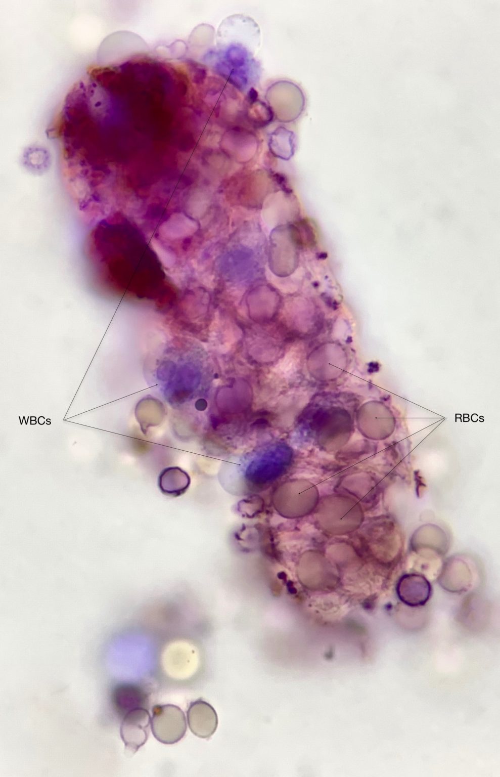 Urine Sediment of the Month: Mixed Cellular Casts - Renal Fellow Network
