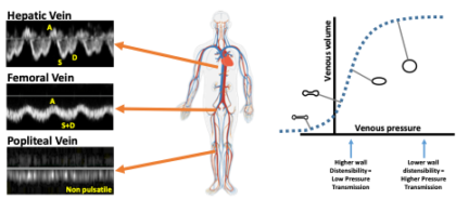 Evaluation of Venous Congestion Using Point of Care Ultrasonography ...