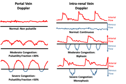 Evaluation of Venous Congestion Using Point of Care Ultrasonography ...