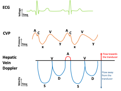 Evaluation of Venous Congestion Using Point of Care Ultrasonography ...