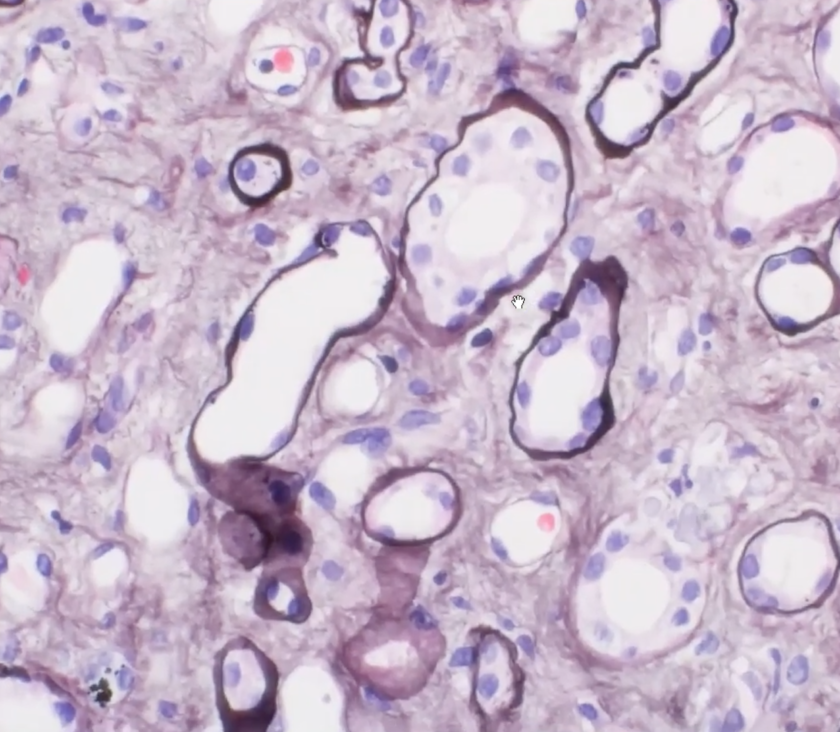 Urine Sediment of the Month: Mixed Cellular Casts - Renal Fellow Network