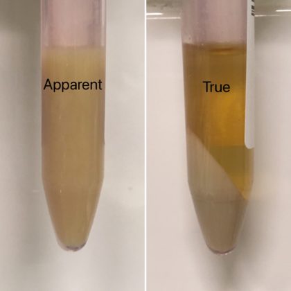 Urine Sediment of the Month: Urine's True Colors - Renal Fellow Network