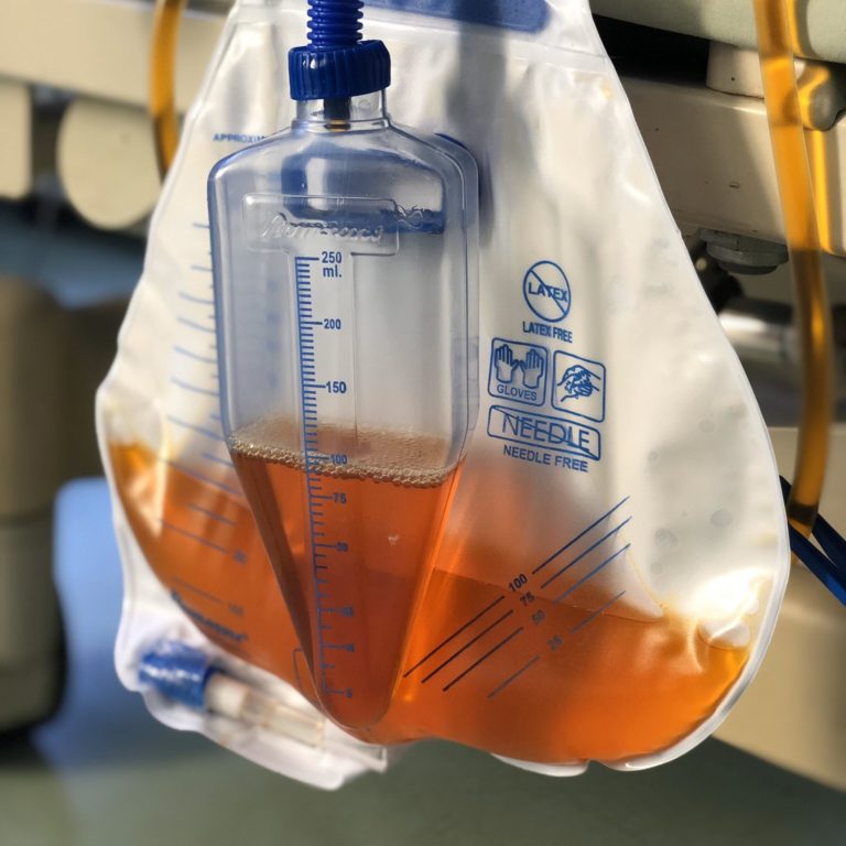 Urine Sediment of the Month: Urine's True Colors - Renal Fellow Network