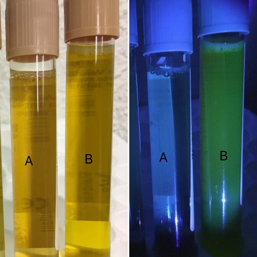 Urine Sediment of the Month: Urine's True Colors - Renal Fellow Network
