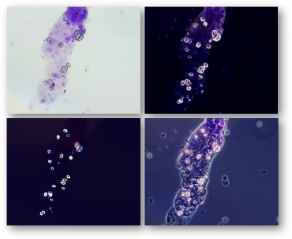 Urine Sediment of the Month: Crystal Casts - Renal Fellow Network