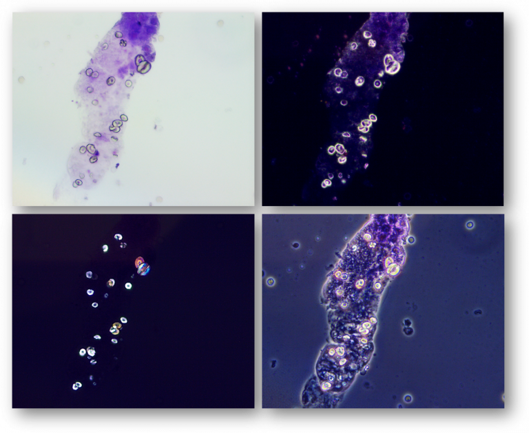 Urine Sediment of the Month: Crystal Casts - Renal Fellow Network