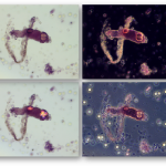 Urine Sediment of the Month: Crystal Casts - Renal Fellow Network
