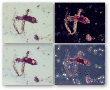 Urine Sediment of the Month: Crystal Casts - Renal Fellow Network