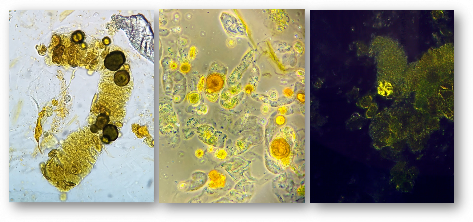 Urine Sediment of the Month: Crystal Casts - Renal Fellow Network