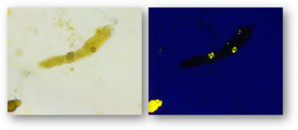 Urine Sediment of the Month: Crystal Casts - Renal Fellow Network