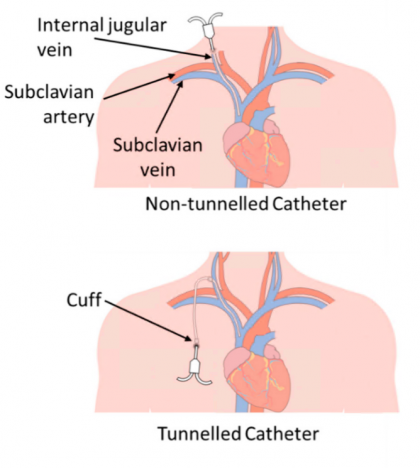 Dialysis Catheters 101 - Renal Fellow Network