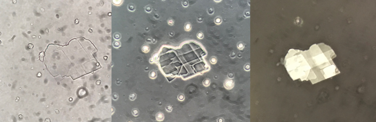 Urine Sediment of the Month: Pathologic Crystals in the Urine - Renal ...