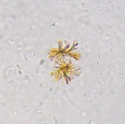 Urine Sediment of the Month: Pathologic Crystals in the Urine - Renal ...