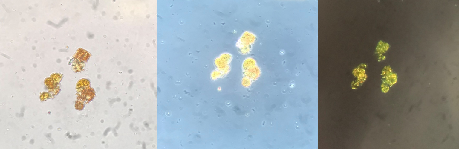 Urine Sediment of the Month: Pathologic Crystals in the Urine - Renal ...