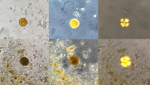 Urine Sediment of the Month: Pathologic Crystals in the Urine - Renal ...
