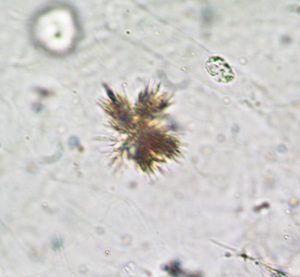 Urine Sediment of the Month: Pathologic Crystals in the Urine - Renal ...