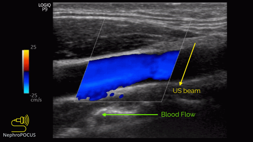 Basics of Doppler Ultrasound for the Nephrologist: Part 1 - Renal ...