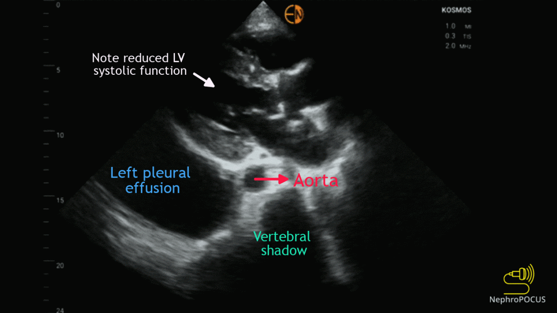 Identification of Various Effusions on Standard Echocardiographic Views ...