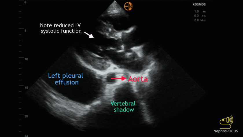 Identification of Various Effusions on Standard Echocardiographic Views ...
