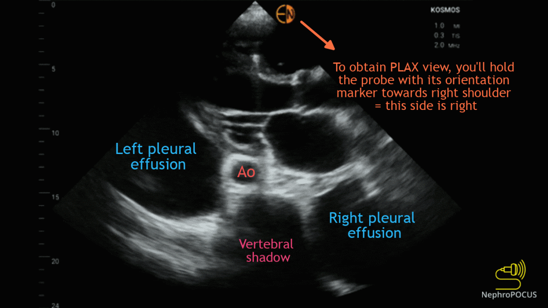 Identification of Various Effusions on Standard Echocardiographic Views ...