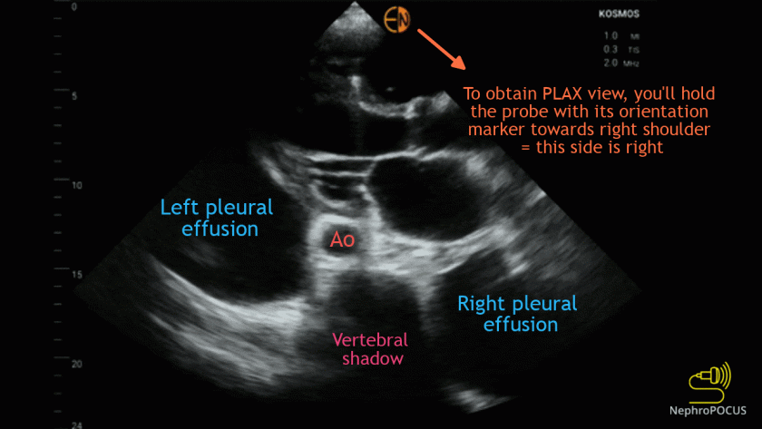 Identification of Various Effusions on Standard Echocardiographic Views ...