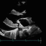 Identification of Various Effusions on Standard Echocardiographic Views ...