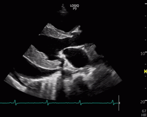 DKA in Patients on Dialysis and Anuria: Pathophysiology, Pearls, and ...