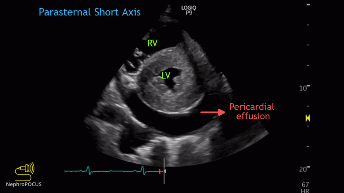 Identification of Various Effusions on Standard Echocardiographic Views ...