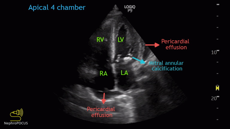 Identification of Various Effusions on Standard Echocardiographic Views ...
