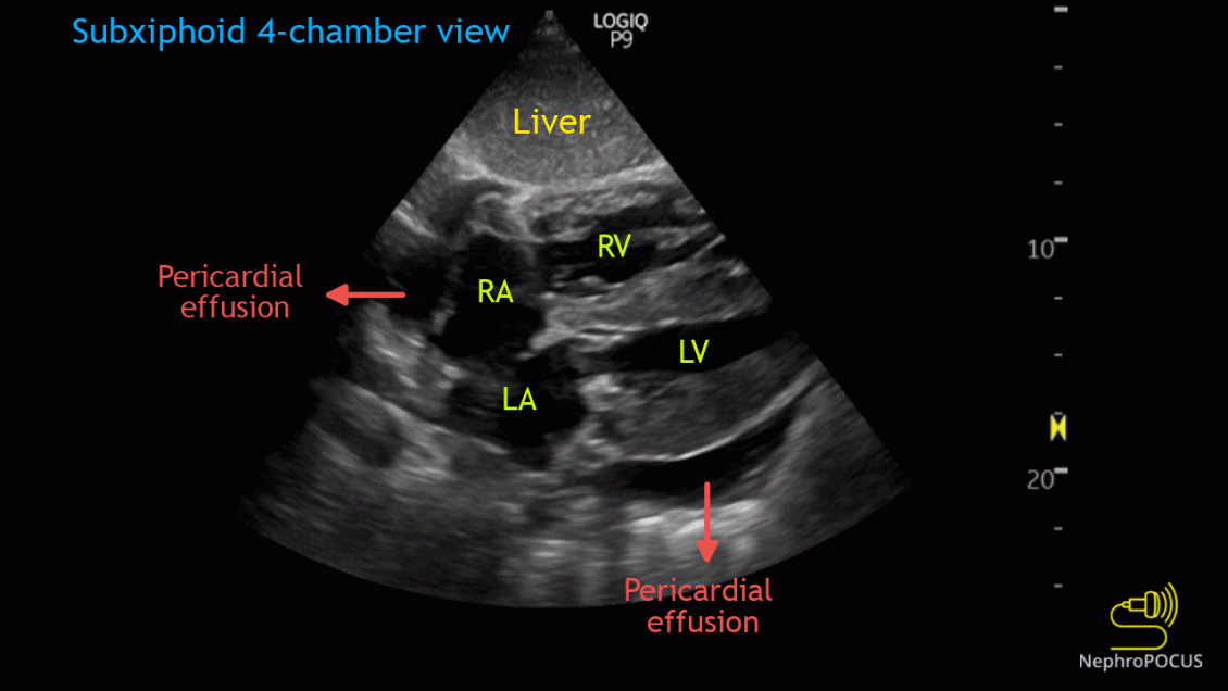 Identification of Various Effusions on Standard Echocardiographic Views ...