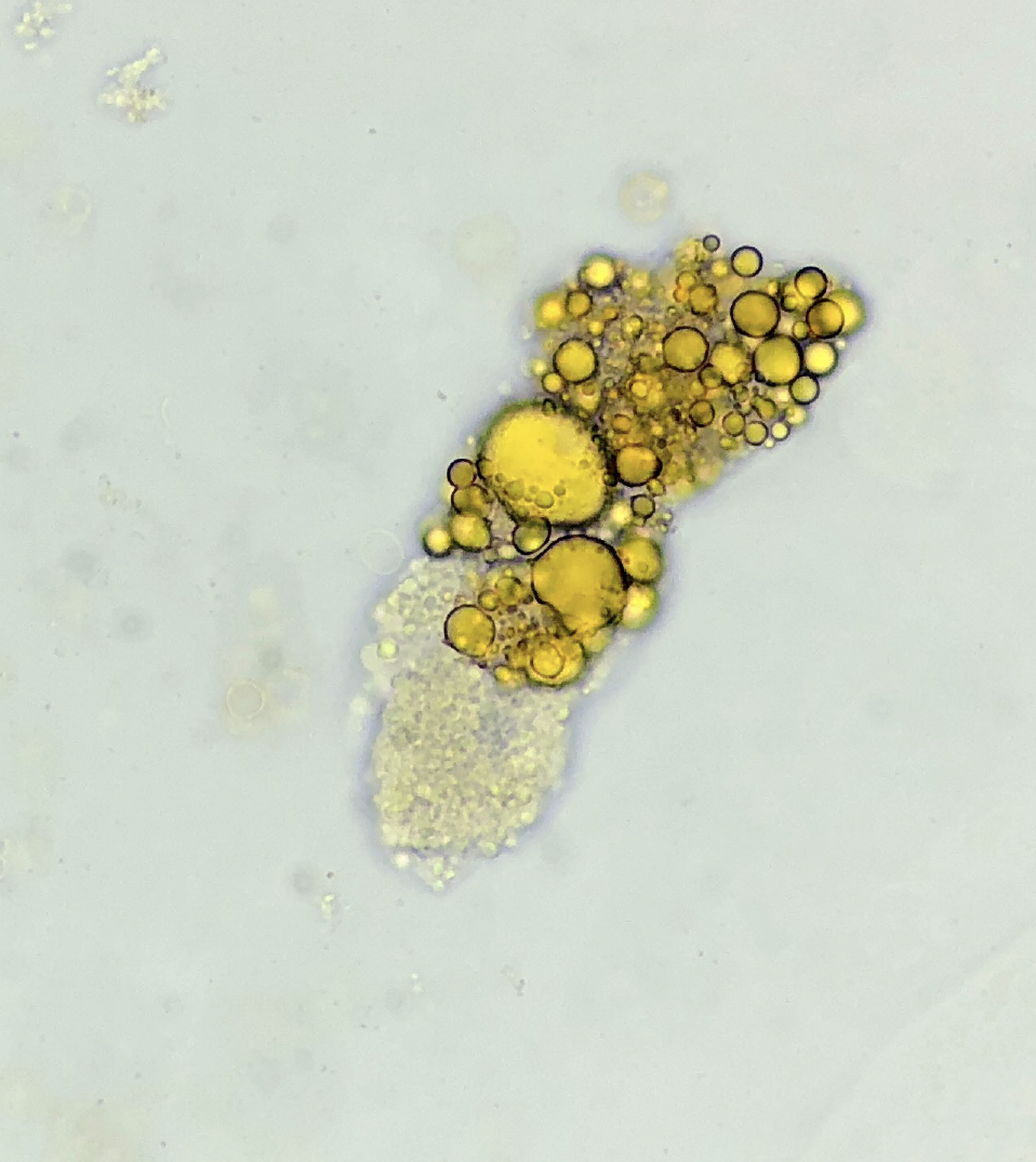 Urine Sediment of the Month: To Stain or Not to Stain - Renal Fellow ...