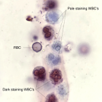 Urine Sediment of the Month: To Stain or Not to Stain - Renal Fellow ...
