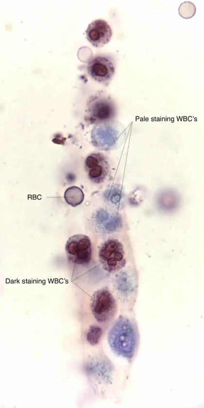 Urine Sediment of the Month: To Stain or Not to Stain - Renal Fellow ...
