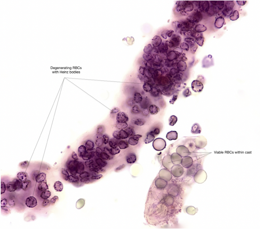 Urine Sediment of the Month: To Stain or Not to Stain - Renal Fellow ...