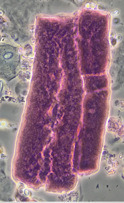 Urine Sediment of the Month: To Stain or Not to Stain - Renal Fellow ...