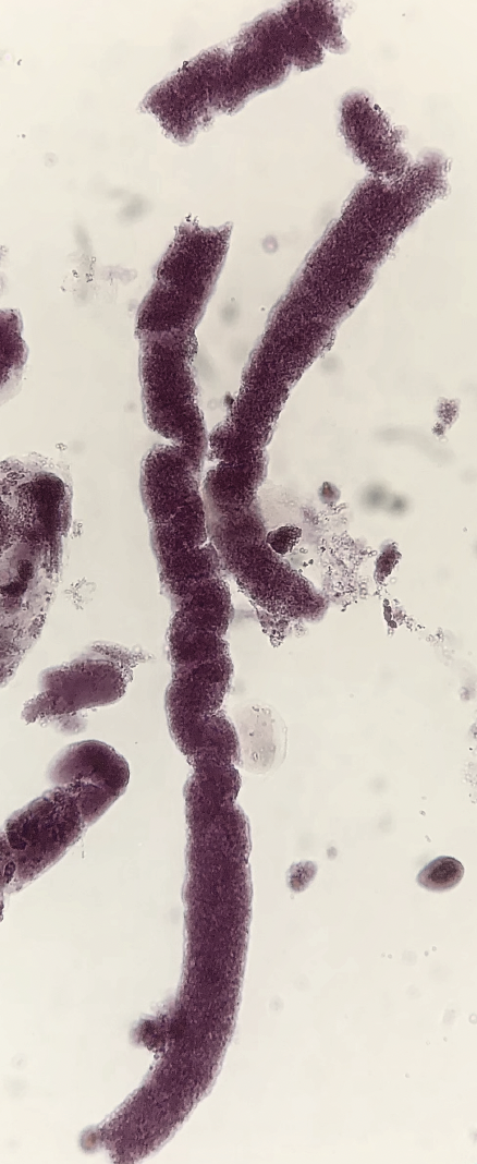 Urine Sediment of the Month: To Stain or Not to Stain - Renal Fellow ...