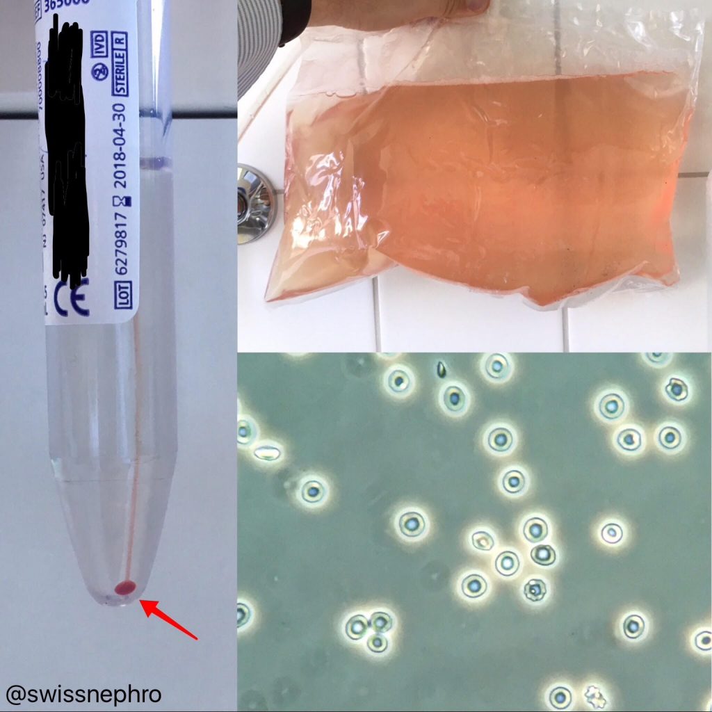 Urine Sediment of the Month: Beyond the Urizon - Renal Fellow Network