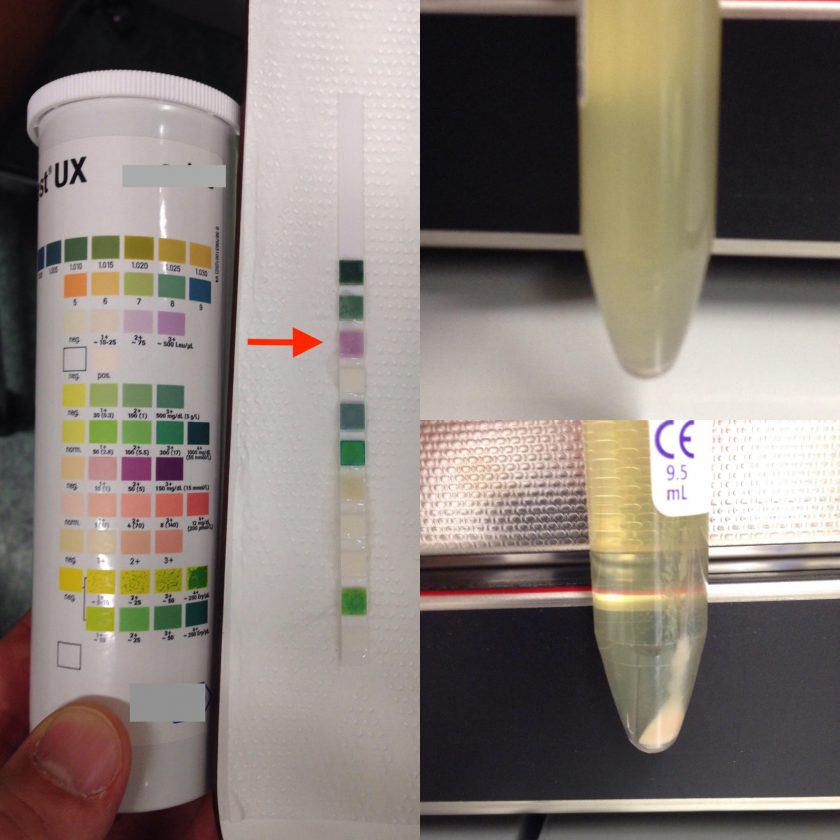 Urine Sediment of the Month: Beyond the Urizon - Renal Fellow Network