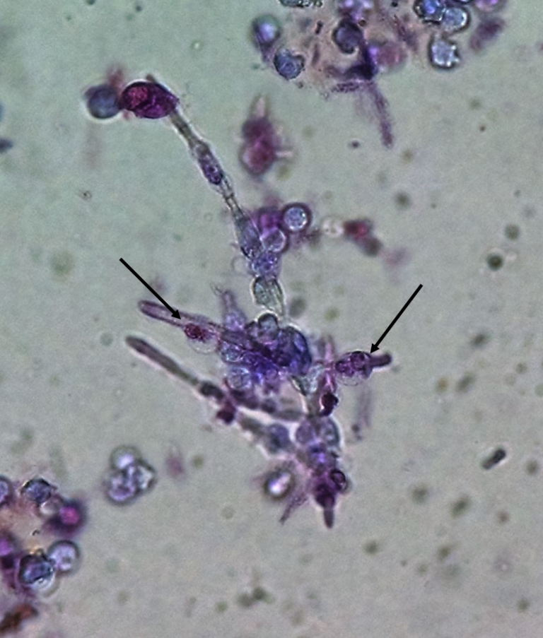 Urine Sediment of the Month: Identifying Phagocytosed Particles - Renal ...