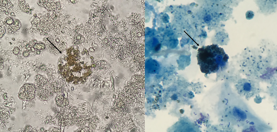 Urine Sediment of the Month: Identifying Phagocytosed Particles - Renal ...